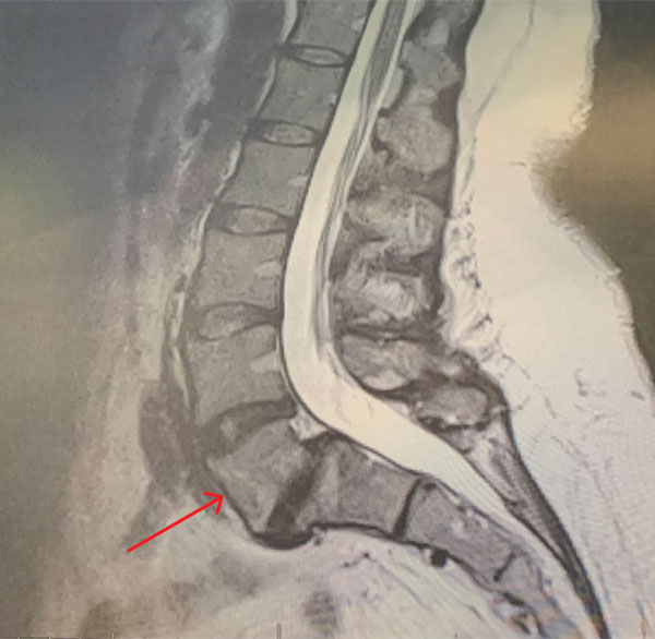 Spine :: Laminectomy and Fusion Solves Decades of Back Pain