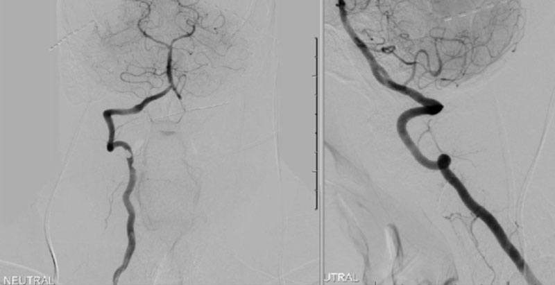 Endovascular :: Right Vertebral Artery Compression Syndrome