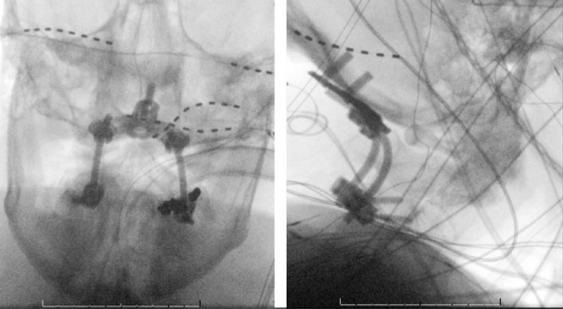 Endovascular :: Right Vertebral Artery Compression Syndrome