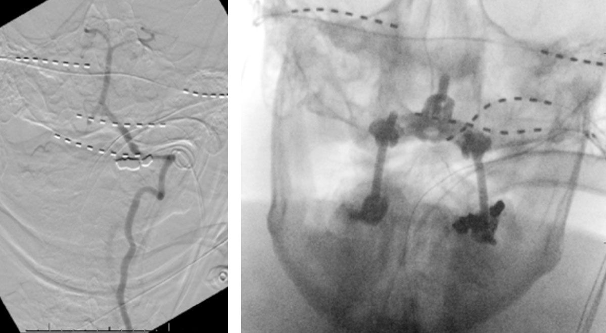 Endovascular :: Right Vertebral Artery Compression Syndrome