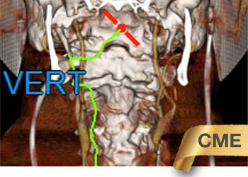 Endovascular :: Right Vertebral Artery Compression Syndrome
