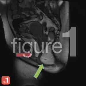Cystocele and rectocele on MRI proctogram