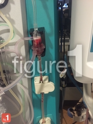 Chronic renal replacement therapy machine with a clot
