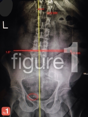 lumbarization of S1 on X-ray