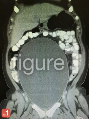 Distended bladder in a post-partum female