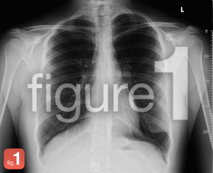 Viral bronchitis and asthma on chest Xray