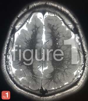 Bilateral frontoparietal polymicrogyria on MRI