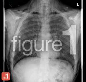 Hamman's syndrome on chest Xray