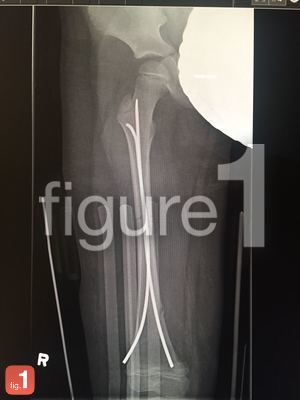 Xray of flexi-nail fixation of a mid-shaft femur fracture