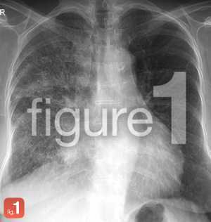 Asymmetric interstitial opacities on chest xray