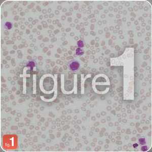 Acute monoblastic leukemia on histology