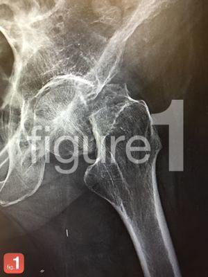 Left femoral neck fracture
