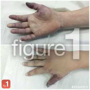 Acute ischemia of the hand