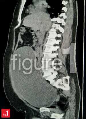 Distended bladder and severe hydronephrosis on CT