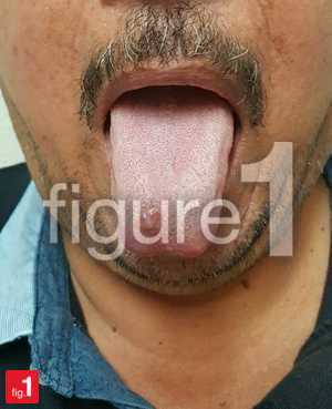 Neoplasm on the tongue as pyogenic granuloma