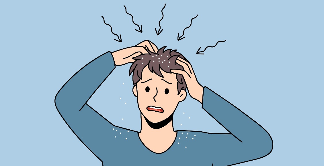 Guía definitiva para erradicar la caspa