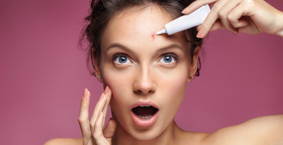 Todo lo que una persona con acné debe saber