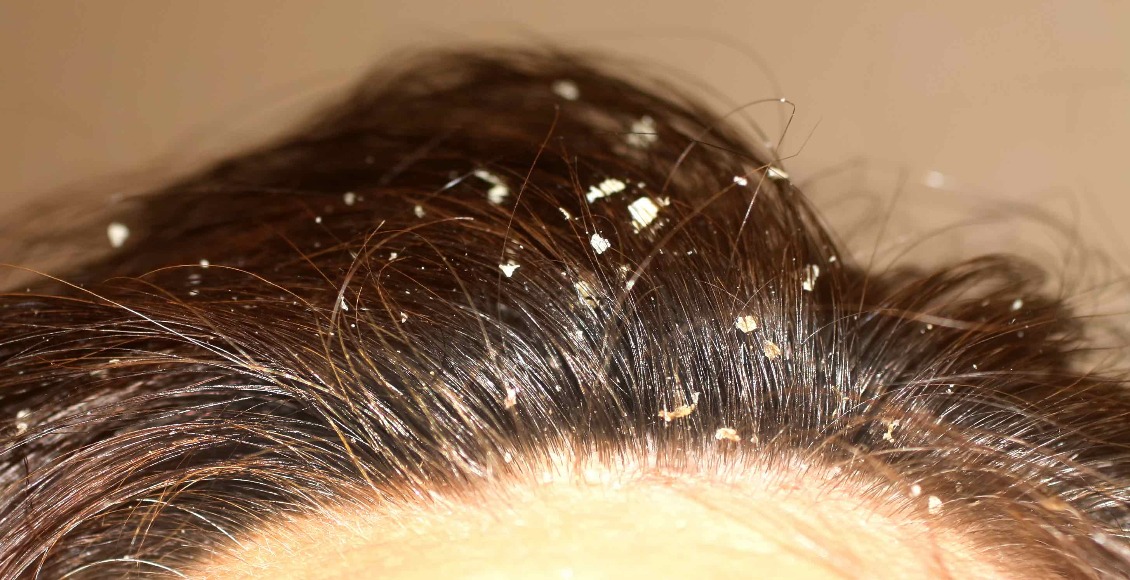 Todo lo que una persona con caspa tiene que saber