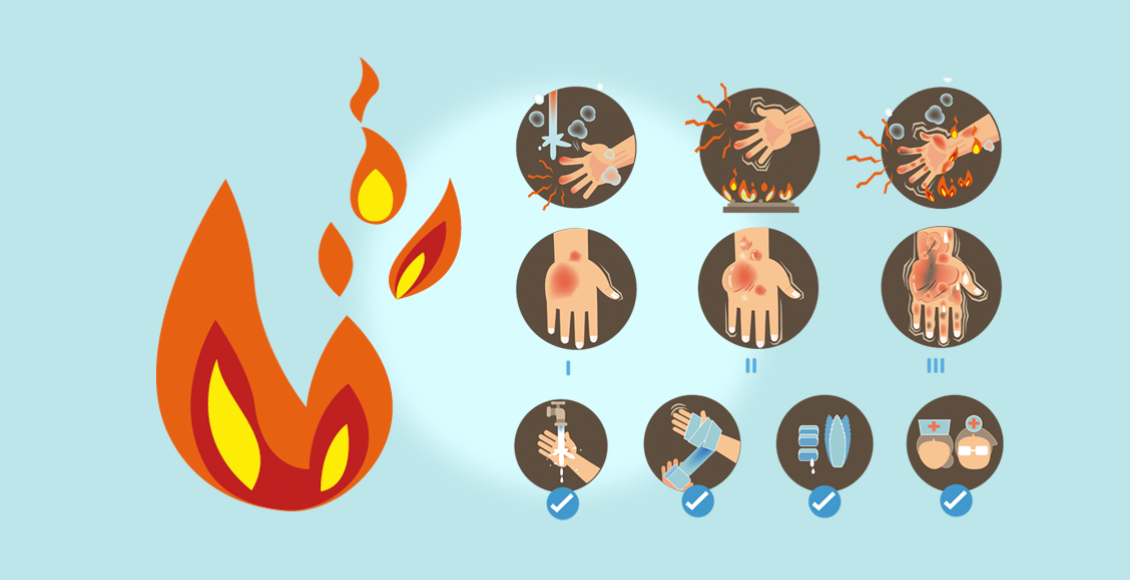 Quemaduras: síntomas y consejos para curarlas