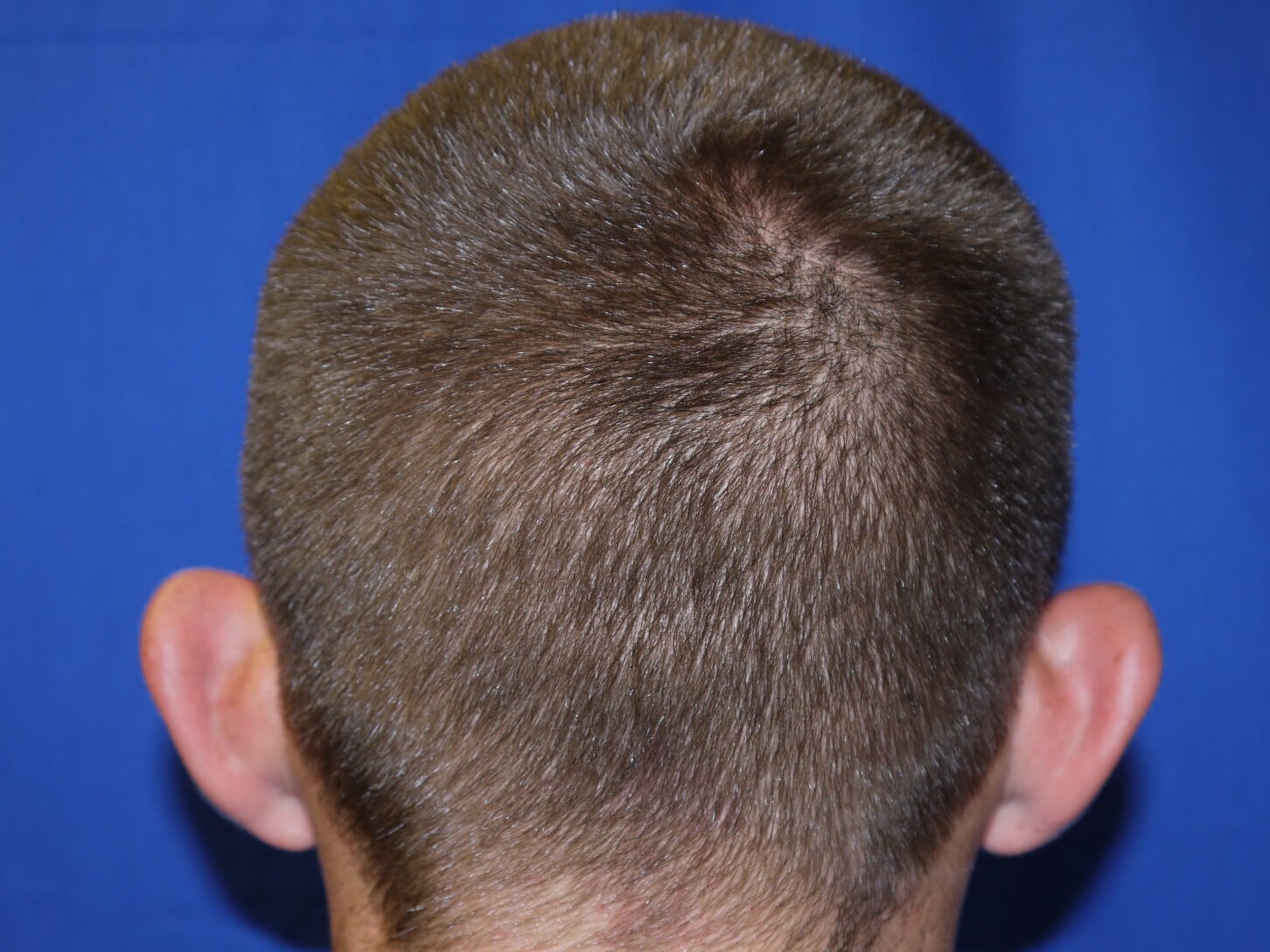 Ear Surgery Before & After - Otoplasty | Plastic Surgeon Scottsdale AZ