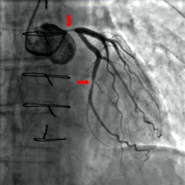 Vasculature of the Heart - TeachMeAnatomy