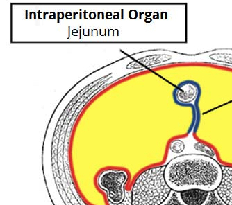 Gastrointestinal Perforation - Aetiology - Management - TeachMeSurgery