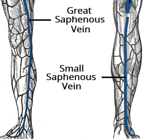 Varicose Veins - Clinical Features - Management - TeachMeSurgery
