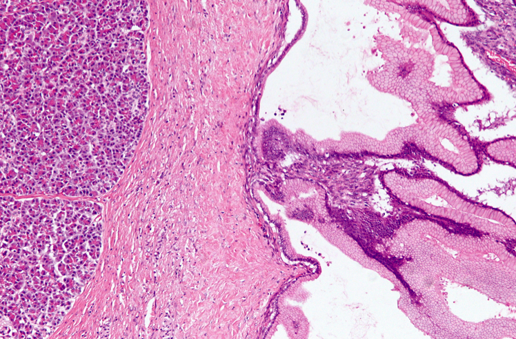 Pancreatic Cysts - TeachMeSurgery