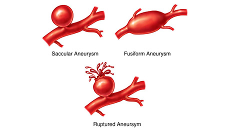 Brain Aneurysms - Information from Mount Sinai Hospital - The Bee ...