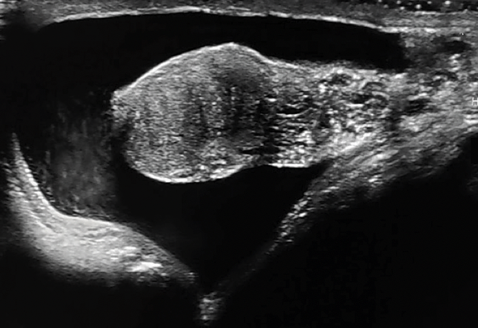 Epididymitis Ultrasound
