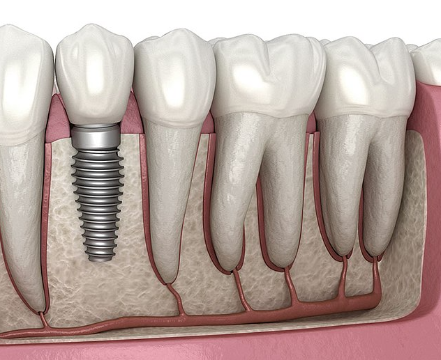 Dental Implants in Crown Point Indiana - Anderson Dental Professionals ...