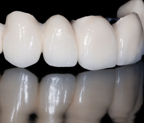 Fixed Bridges: Natural Look, Secure Fit, Quick Procedure with Fixed ...