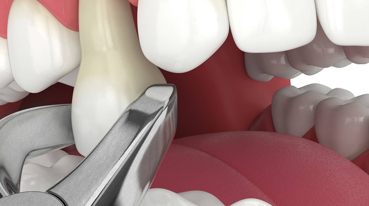 Extractions: Experience a pain-free procedure with our advanced ...