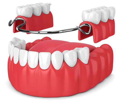 Dentures: Get The Best Dentures from Anderson Dental Professionals ...
