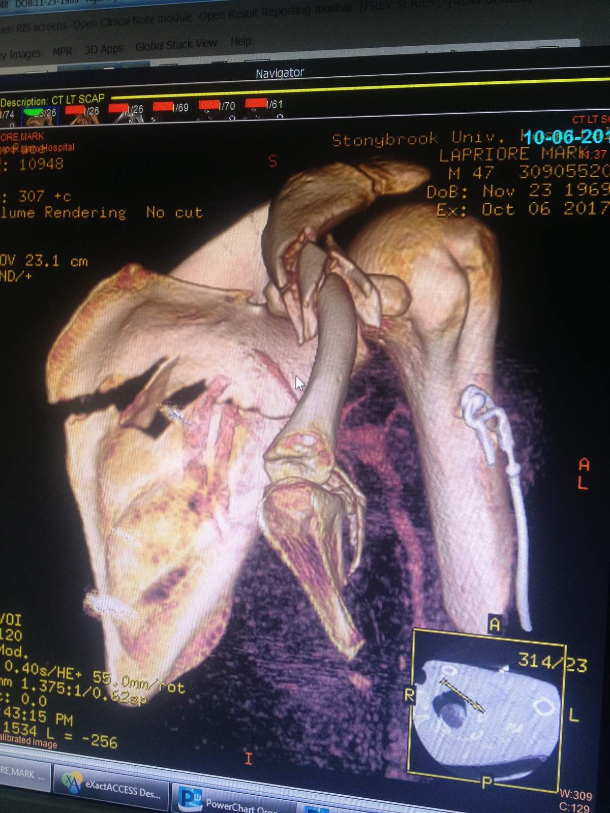 Your worst bmx injury - BMXmuseum.com Forums