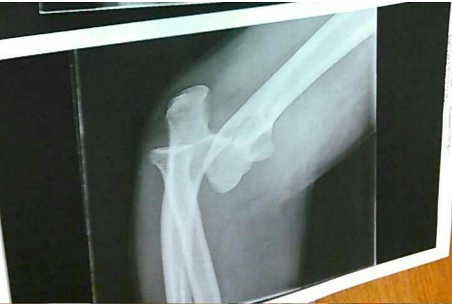 Your worst bmx injury - BMXmuseum.com Forums