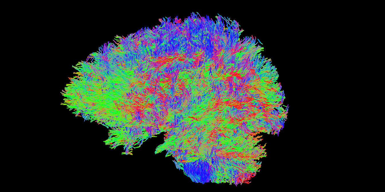 Neuroimaging & Artificial Intelligence Help Detect Brain Changes | Dell ...