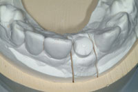 LMTmag | BIOMET 3i Gold-colored Encode® Abutments Eliminate Gray Hue ...