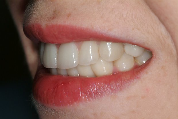 LMTmag | Full Contour Zirconia Case Studies | Prettau® Zirconia From Zirkonzahn