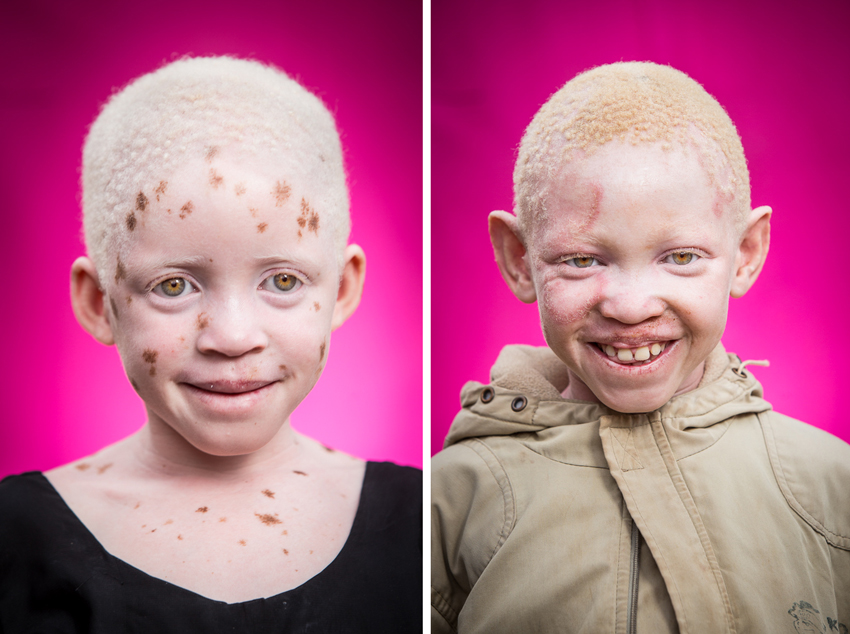 Spotlight: Christopher Beauchamp on Albinism & East Africa | Wonderful ...