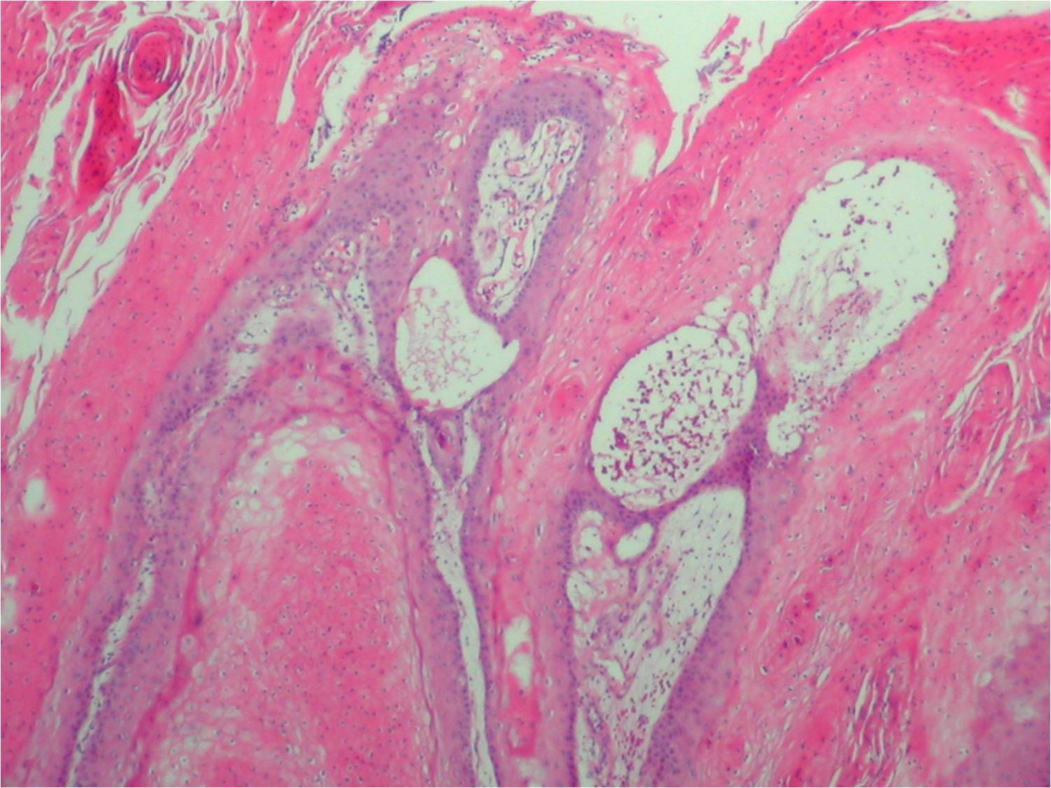 Marjolin's Ulcer - The Hauns in Africa