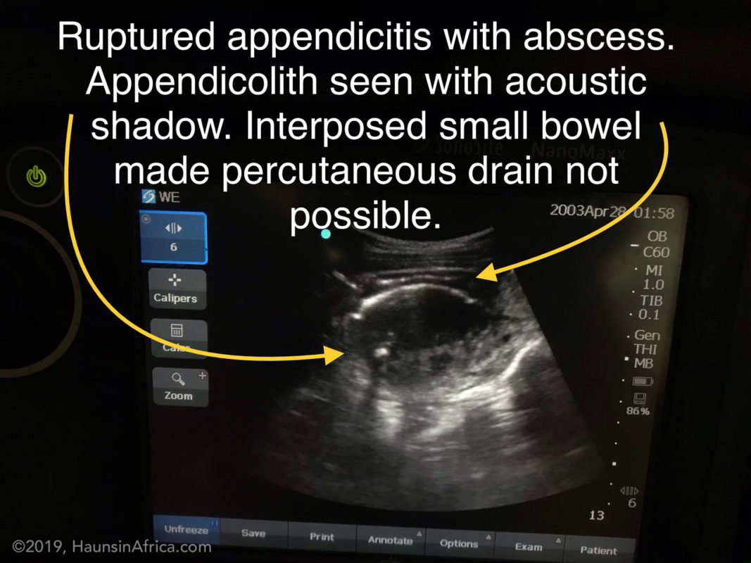 Ruptured Appendicitis - The Hauns in Africa