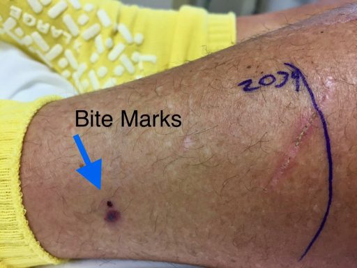 Trail First Aid: Snakebites in North America – iRunFar