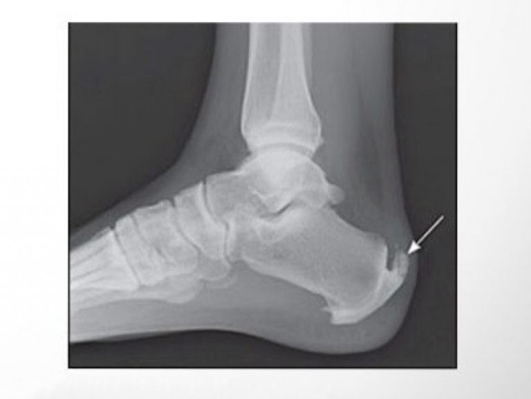 Haglund’s Deformity and Other Causes of Heel Pain in Runners – iRunFar