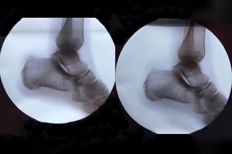 Haglund’s Deformity and Other Causes of Heel Pain in Runners – iRunFar