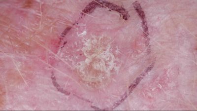 Identifying Skin Cancer: 37 Photos You Need to See - Stories by weather ...