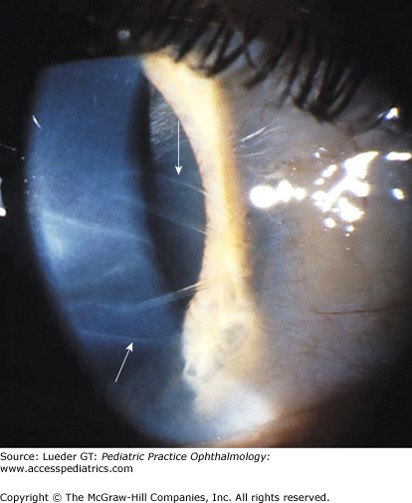 Cloudy Cornea Diagnosis | AccessMedicine Network