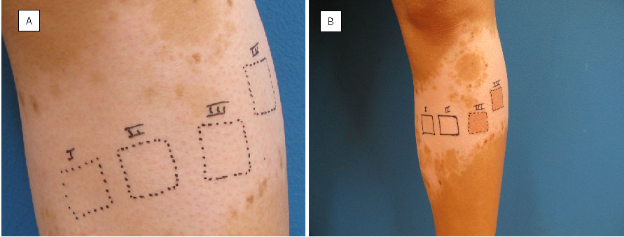 Skin Regeneration Symposium Cambridge, 12-13 April 2016 Part 3 | RegMedNet