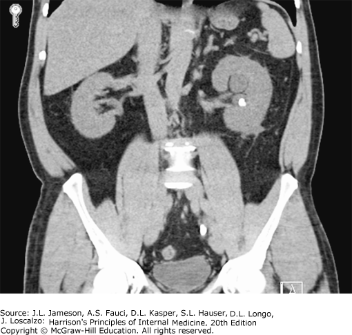 Renal Calculi on CT | AccessMedicine Network