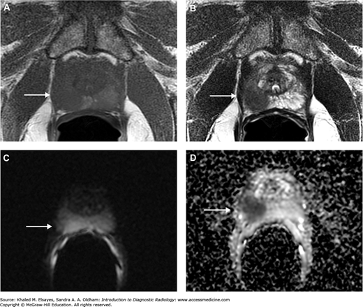 Prostate Cancer on MRI | AccessMedicine Network